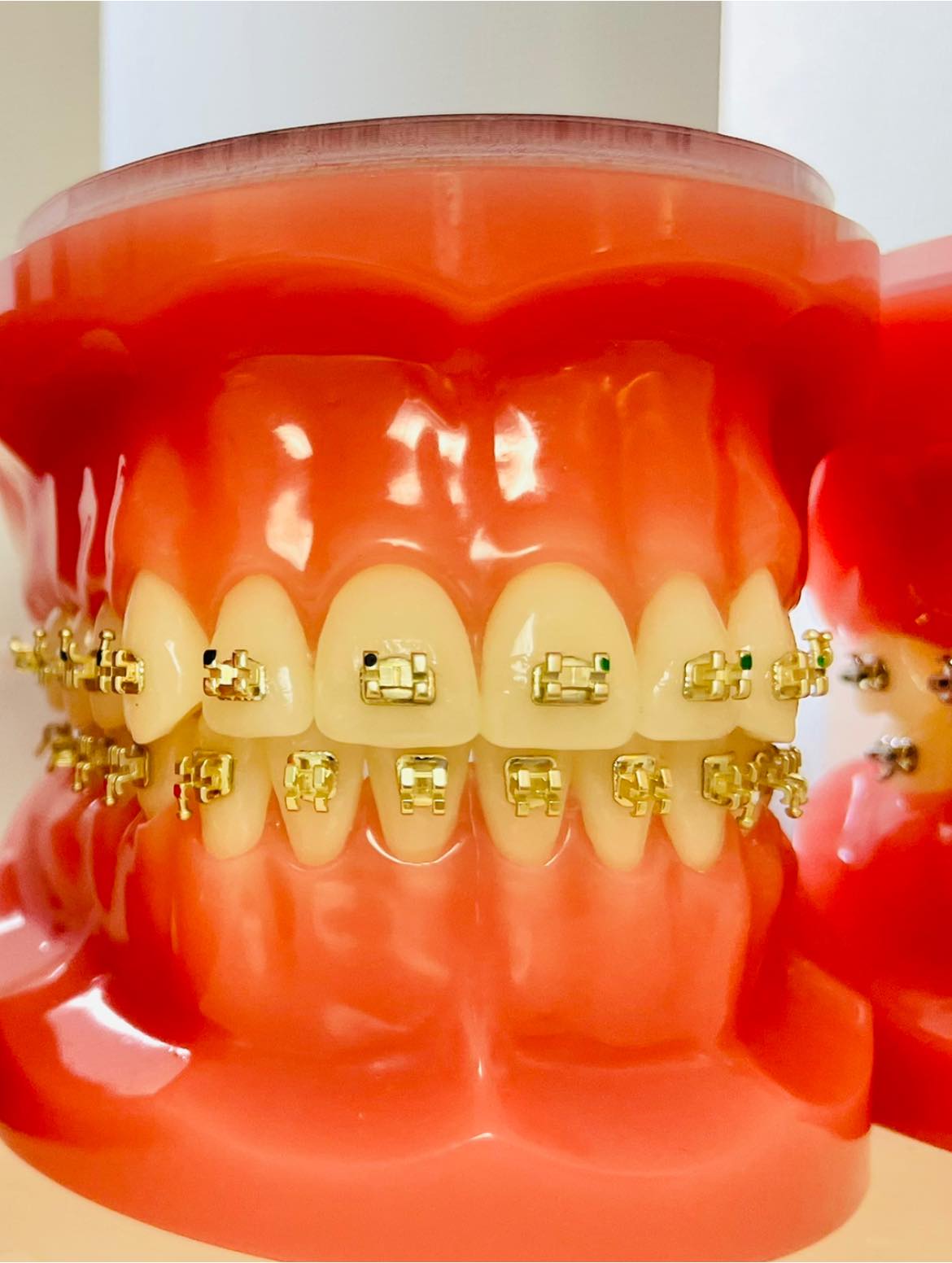 Types of braces – Dr. Ljubica Banić