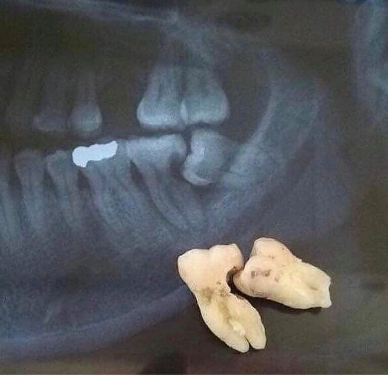 Impact of the 3rd molar to the neighbour teeth – Dr. Ljubica Banić