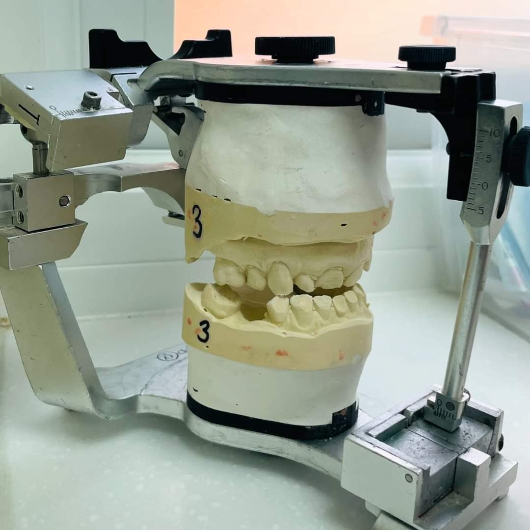What Is An Articulator and How Is It Used In Dentistry? – Dr. Ljubica Banić